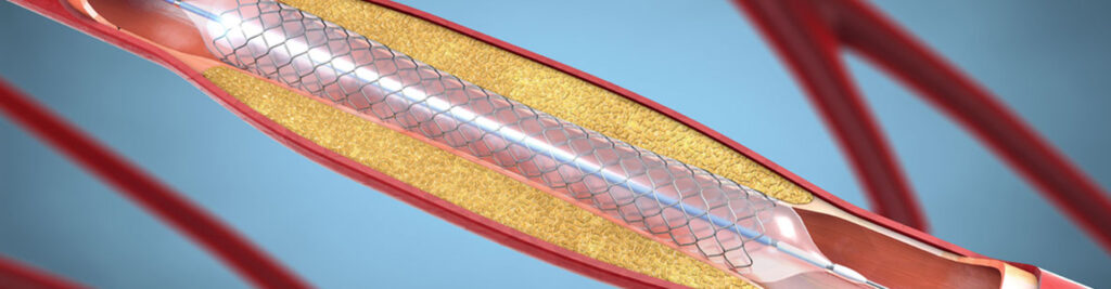 Stent Placement in a Heart Vessel – Prof.Dr. Muzaffer Değertekin